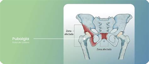 Pubalgia