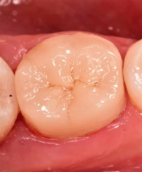 Partial Coverage With Lithium Disilicate Overlay Myzerodonto