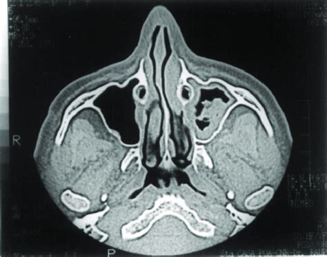 A Computed Tomographic Scan Shows Partial Opacification Of The Left Download Scientific Diagram
