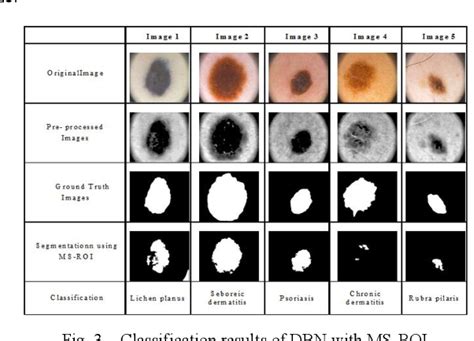 An Erythemato Squamous Disease Esd Detection Using Dbn Technique Semantic Scholar
