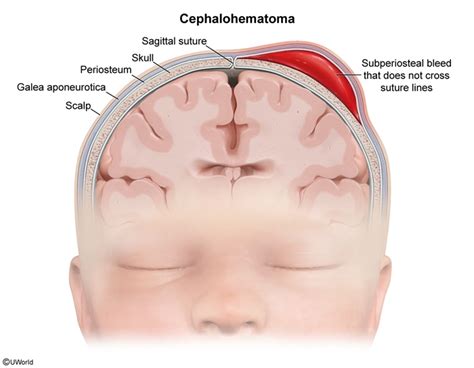 Cephalohematoma And Jaundice