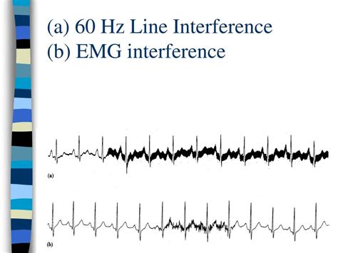 Ekg 60 Cycle Interference Types Of Ecg Uqjfk
