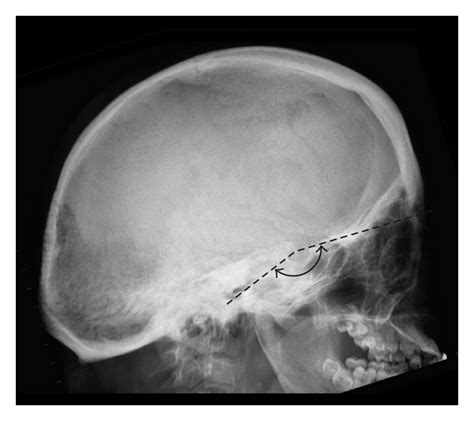Platybasia Xray