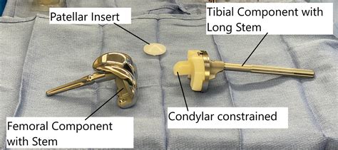 Knee Arthroplasty Implants Complete Orthopedics And Podiatry