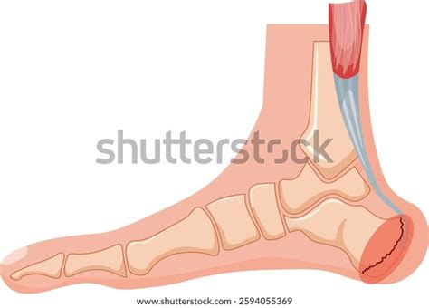 Severs Disease Calcaneal Apophysitisis Common Cause Stock Vector