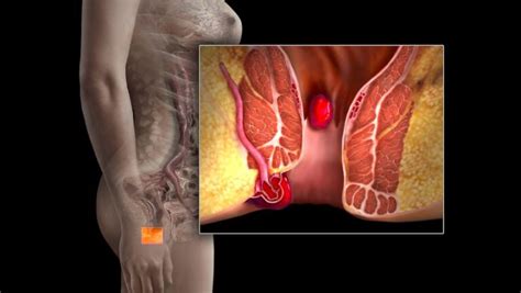 Do Hemorrhoids Go Away On Their Own When To Seek Treatment