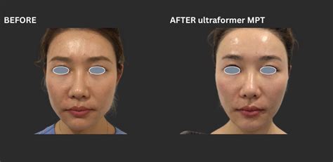 Ultraformer Mpt Hifu Treatment In Adelaide Free Consultation