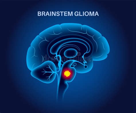 Brainstem Glioma Cancer Stock Illustration Illustration Of Tumor 364016887