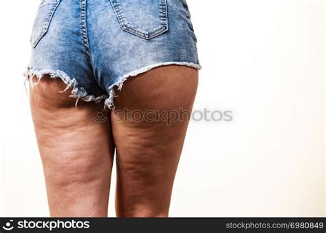 Woman Legs Thighs With Cellulite Skin Problem Body Care Overweight