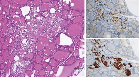 Medullary Microcarcinoma Identified After Sampling The Whole Gland A Download Scientific