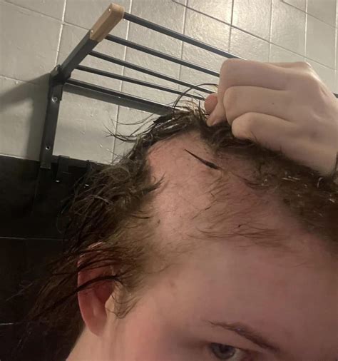 I Wanted Cute Hair Extensions But They Left Me Bald And Bleeding I Was Forced To Shave My