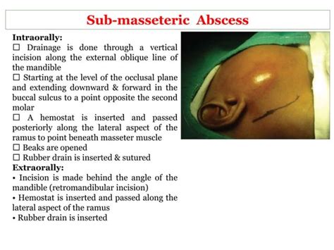 Abscess Oral Maxillo Presentation Pptx