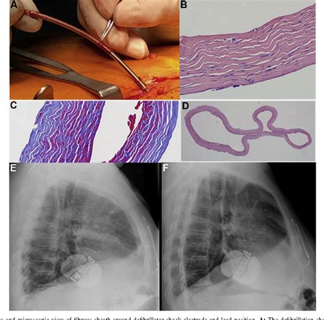 Figure 1 From Fibrous Encapsulation Of Defibrillation Electrode And