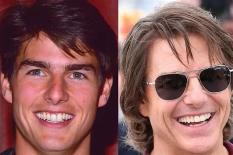 Tom Cruises Teeth The London Lingual Orthodontic Clinic