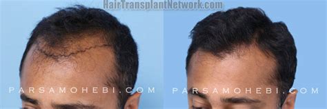 Dr Parsa Mohebi Hair Transplant Procedure Before And After Result