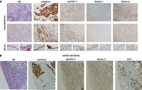 Overexpression Of Gremlin 1 And Fibrillin 2 In Mesothelioma A