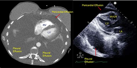Concordance Of Pericardial Effusion Size Between Computed Tomography