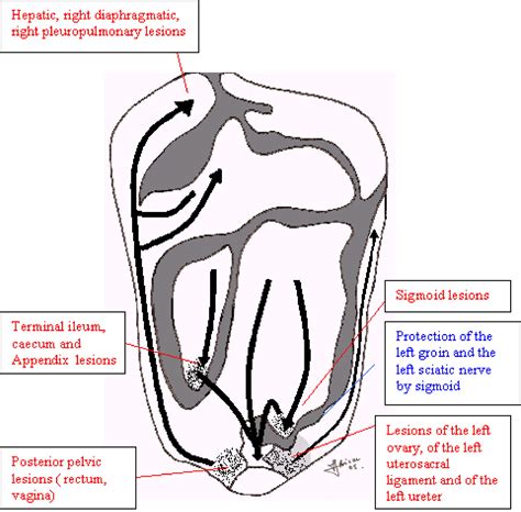 Peritoneal Fluid Flow Influences Anatomical Distribution Of
