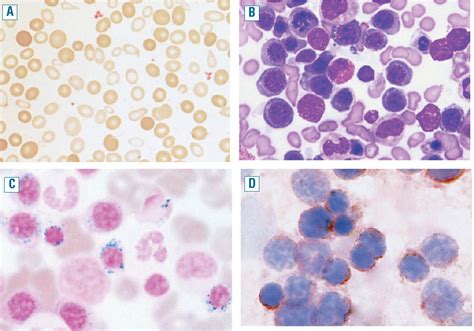 Table 1 From Ring Sideroblasts And Sideroblastic Anemias Semantic Scholar