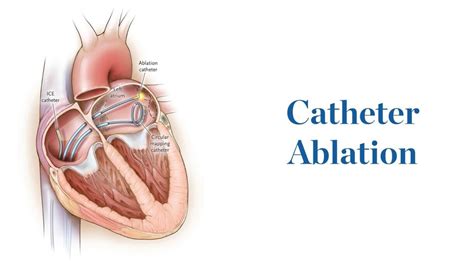 Smooth Recovery Challenges In Aftermath Of Catheter Ablation