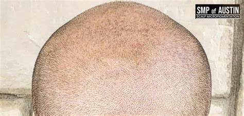 Scalp Micropigmentation For Male Pattern Baldness Smp Of Austin