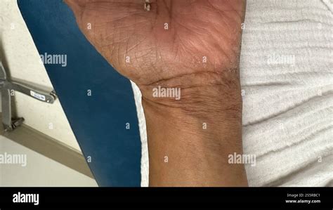 Wrist Of A 62 Year Old Hispanic Female Patient Infected With Scabies Scabies Is Caused By The