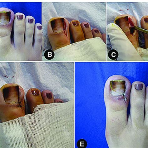A Patient With Igt And Granulation Tissue In The Distal Portion Of