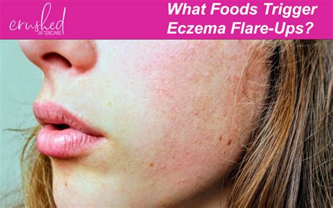 Eczema Flare Ups Foods And Healing Balms Crushed Aftercare