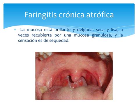 Que Es Una Faringitis Faringitis Síntomas Tratamientos Qué Es