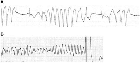 Unveiling Catecholaminergic Polymorphic Ventricular Tachycardia A Case