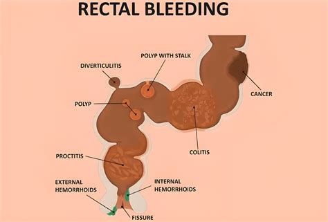 Rectal Bleeding Causes Symptoms And When To See A Doctor