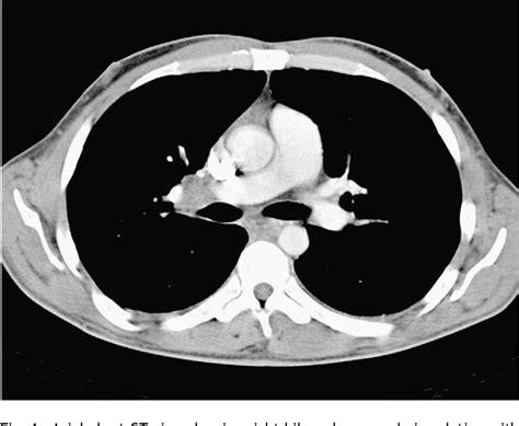 Figure 1 From Case Report Intrapulmonary Lymph Node Metastasis And