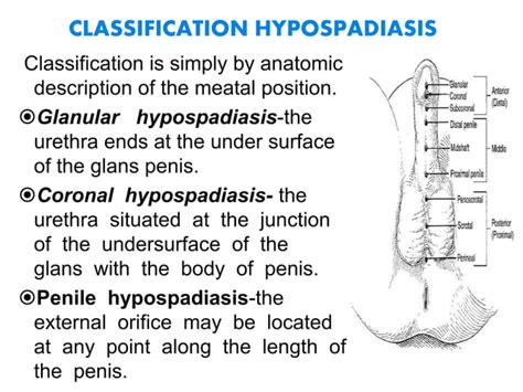 Nursing Management Of Patient With Hypospadiasis And Epispadias Ppt
