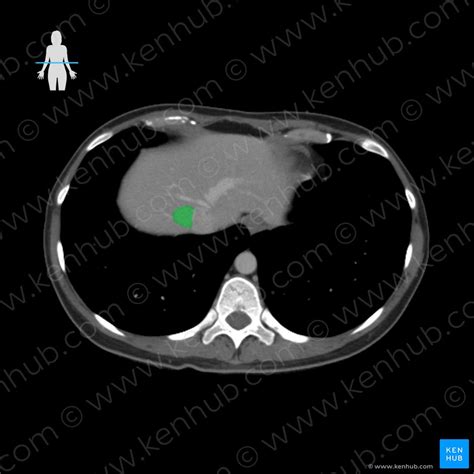 Hepatic Veins Anatomy Tributaries Drainage Kenhub