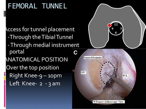 Acl Reconstruction Surgery In Delhi Dr Shekhar Srivastav 09971192233