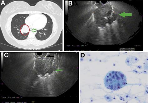 Diagnosis Of Cryptococcus Gattii Infection Based On Endoscopic Ultrasound And Fine Needle