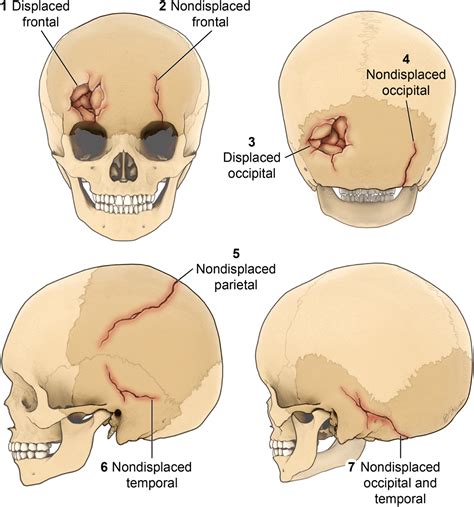 Parietal Occipital Skull Fracture