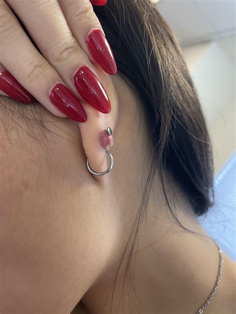 Keloids Piercing