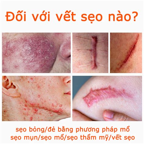 Mua Dùng 1 Cái Sẽ Có Tác Dụng Kem Xóa Sẹo Sửa Chữa Sẹo Những Do Bỏng Phẫu Thuật Sửa Chữa Tất Cả