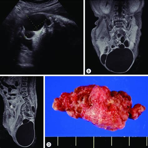 Altman Classification Of Sacrococcygeal Teratoma According To The