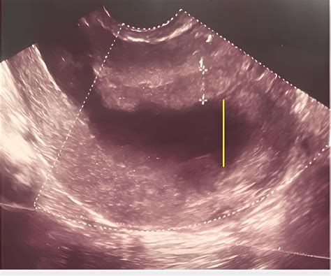 Transvaginal Ultrasound Sagittal Scan Of The Uterus The Endometrial