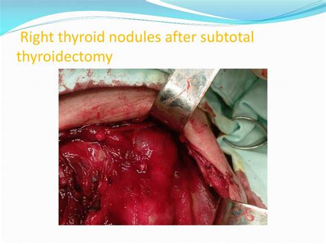 Ppt Hipertiroidii Powerpoint Presentation Free Download Id5412474