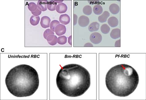 Comparison Between B Microti And P Falciparum Diagnoses Using