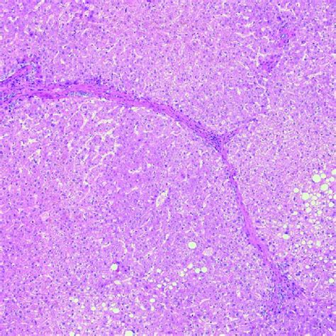 Batts Ludwig Classification System For Staging Fibrosis Download