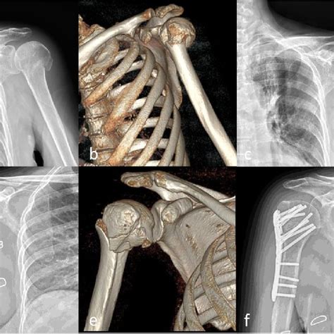 A Radiograph Of A 79 Year Old Woman With Neer Classification Of Download Scientific Diagram