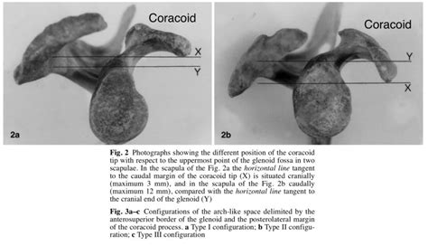 Different Coracoid Process Shapes With Labeling B