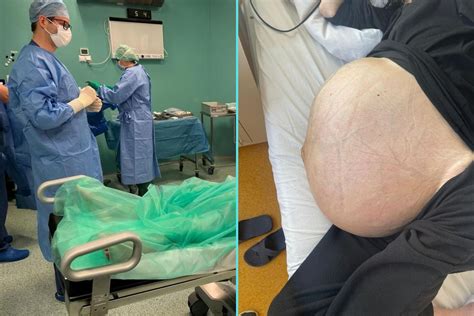 38 Latka Ze Świdnicy Wyhodowała 20 Kg Guza Ten Rak Długo Nie Daje