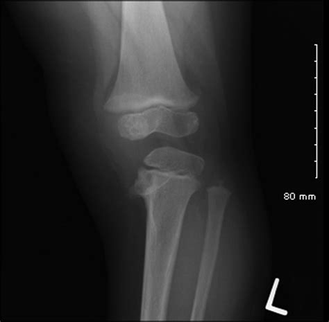 Prominent Beaking Of The Medial Tibial Metaphysis With Lucent Download Scientific Diagram