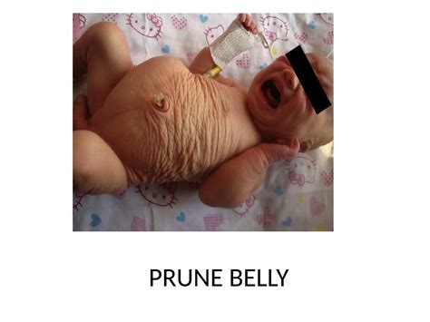 Congenital Anomaly And Congenital Deformity Final 2pptx