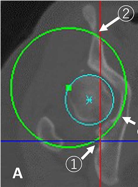 Spherical Periacetabular Osteotomy Archives Orthobuzz